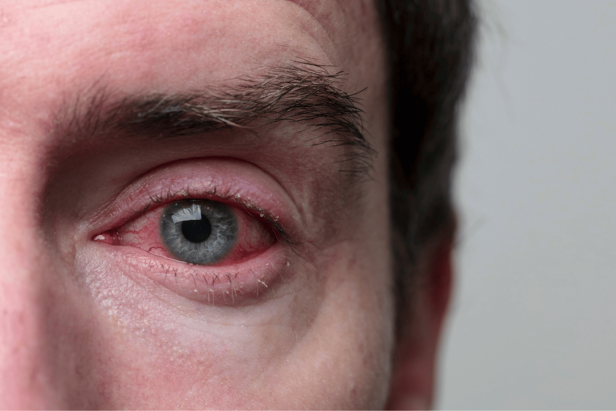 Home Remedies for Pink Eye | Emerald Point Eye Care